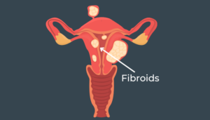 Fibroids Vs Cysts – How Are They Detected? - Dr Mustafa Aldam ...